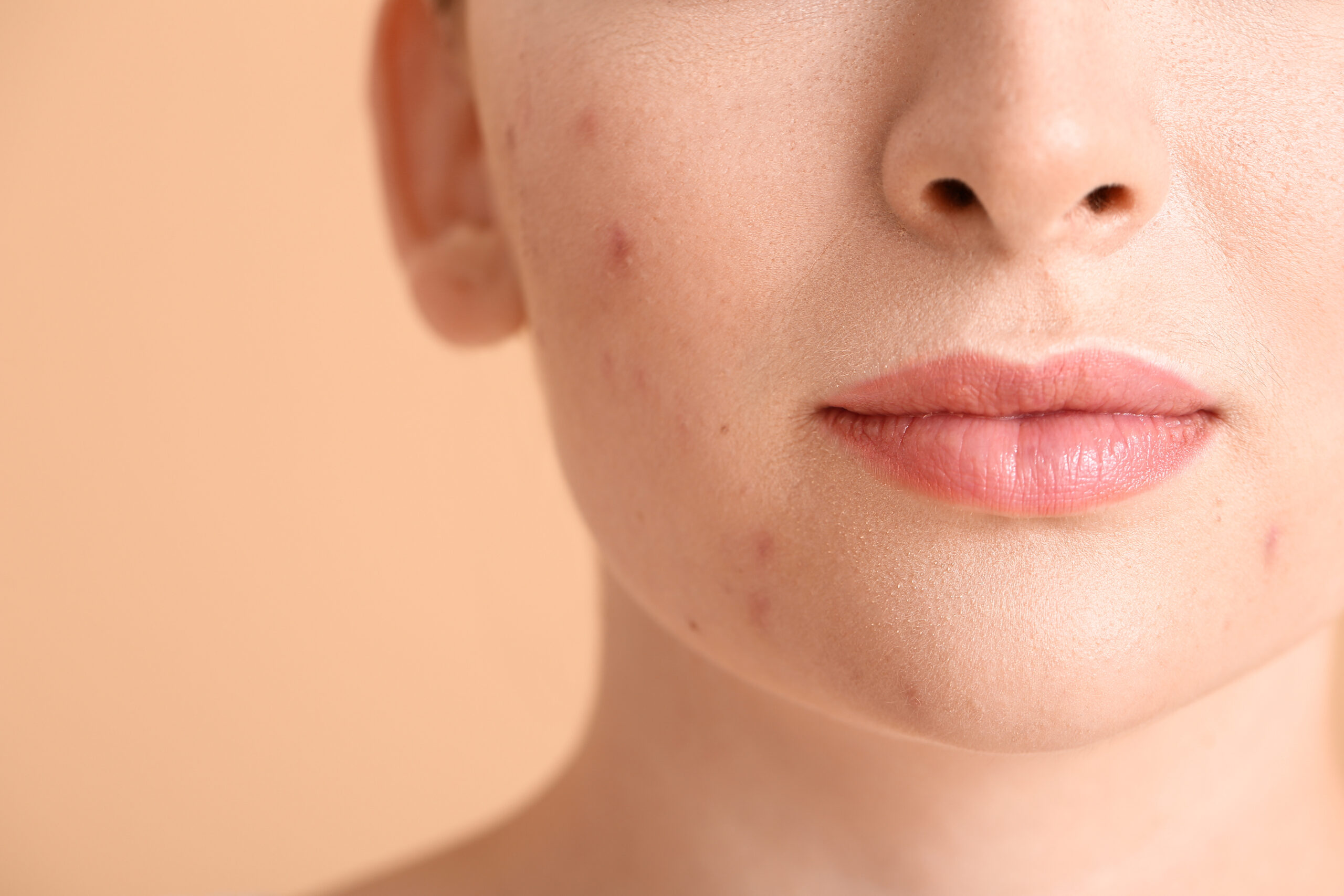 Breaking the Acne Cycle: A Gentler, Faster Approach to Acne Treatment | BGT